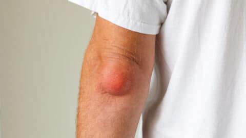 Zachte bult op de elleboog | Elleboogklachten.nl - Dé specialist in ...