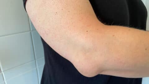 Zachte bult op de elleboog | Elleboogklachten.nl - Dé specialist in ...